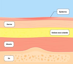 Tout sur l’escarre : définition, prévention, stades et traitement