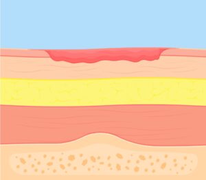 Tout sur l’escarre : définition, prévention, stades et traitement