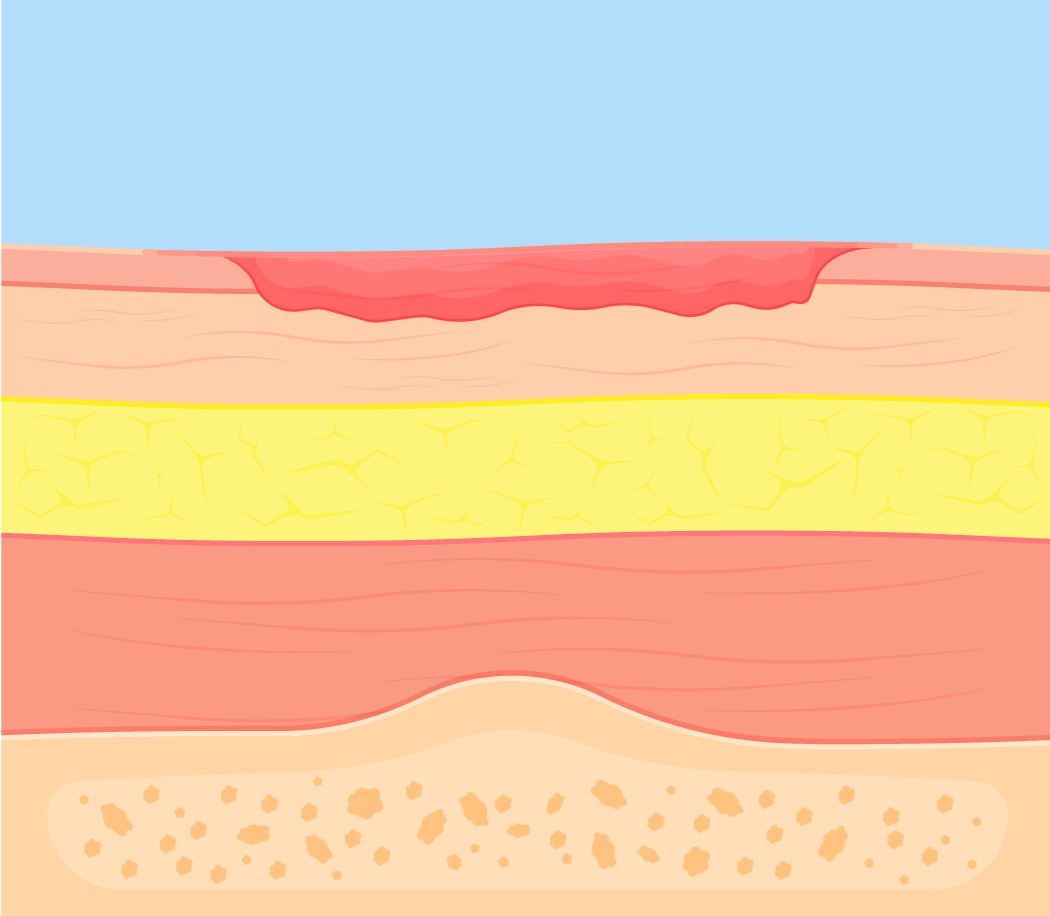 Tout sur l’escarre : définition, prévention, stades et traitement