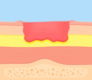 Tout sur l’escarre : définition, prévention, stades et traitement