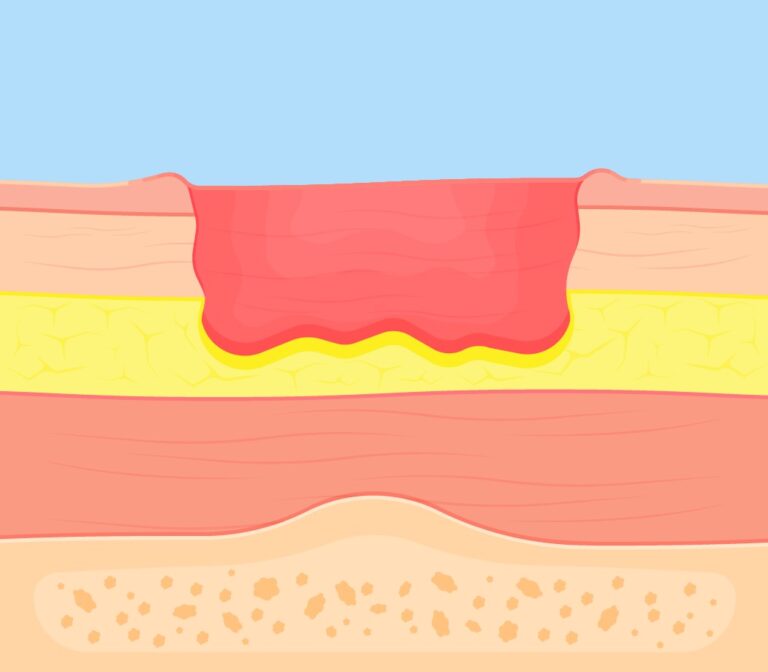 Tout sur l’escarre : définition, prévention, stades et traitement