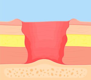 Tout sur l’escarre : définition, prévention, stades et traitement