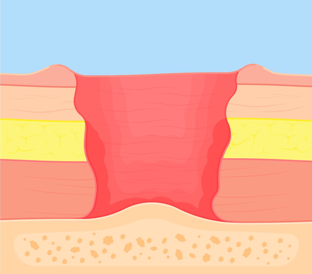 Tout sur l’escarre : définition, prévention, stades et traitement