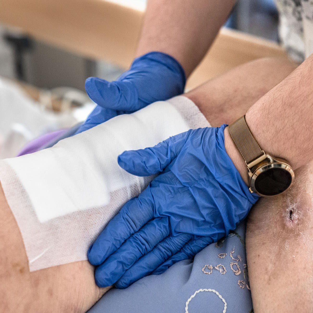 Tout sur l’escarre : définition, prévention, stades et traitement