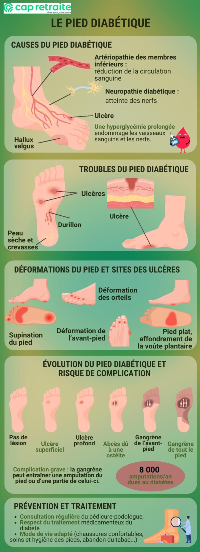 Pied diabétique : les complications du diabète à surveiller