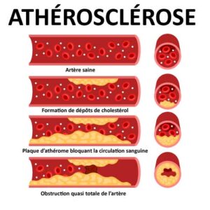 Maladie cardiovasculaire : causes, risques et prévention