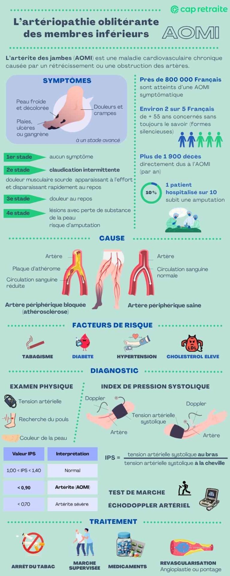 Artérite des jambes (AOMI) : causes, signes et traitements